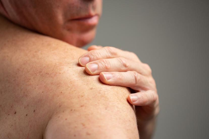 Skin cancer moles on your back? | Track your moles