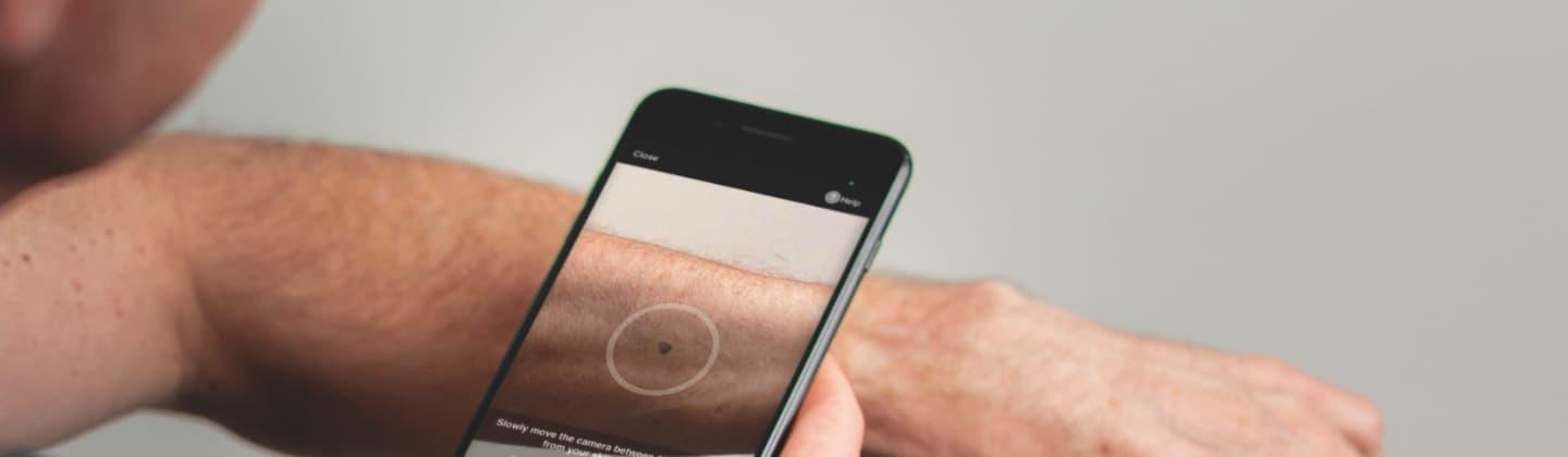 The most common skin lesions (benign) | With Pictures